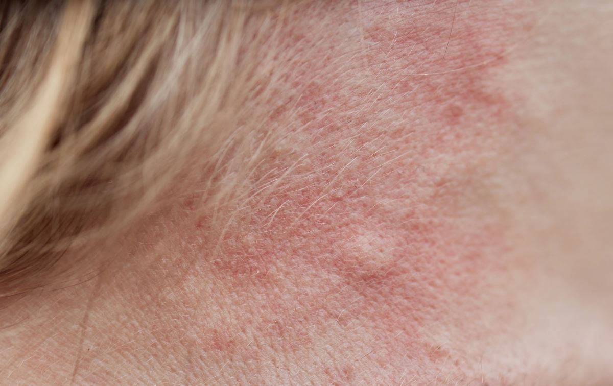 Bettwanzenbisse: sie erkennen und behandeln